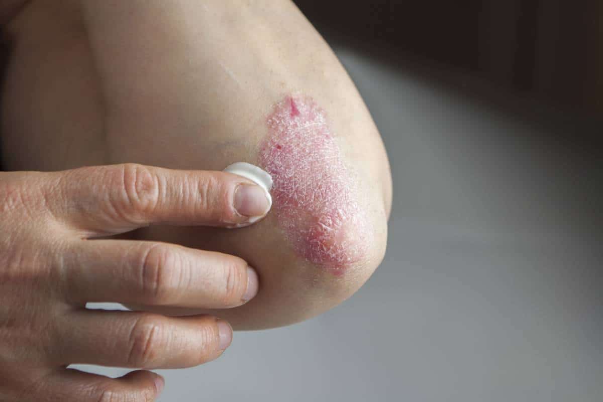 Le pouvoir des plantes dans le traitement naturel du psoriasis | Gnew